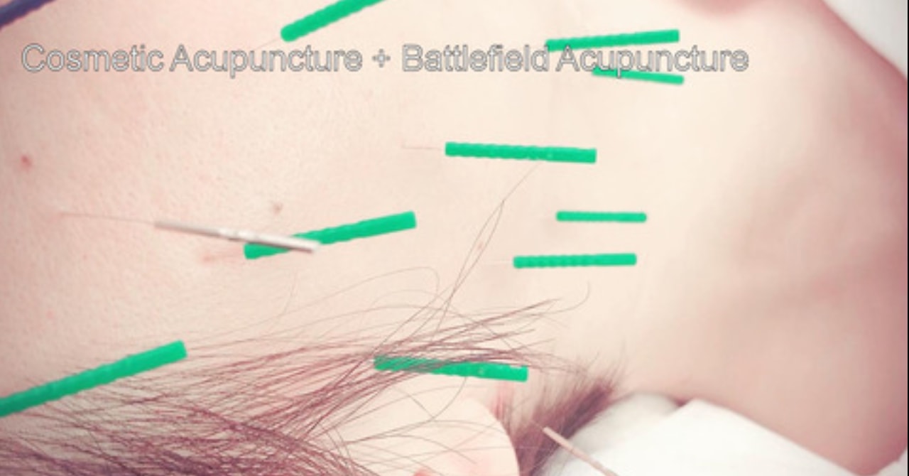 Cosmetic Acupuncture + Battlefield Acupuncture（美顔鍼+バトルフィールド鍼灸）の評判・口コミ ...